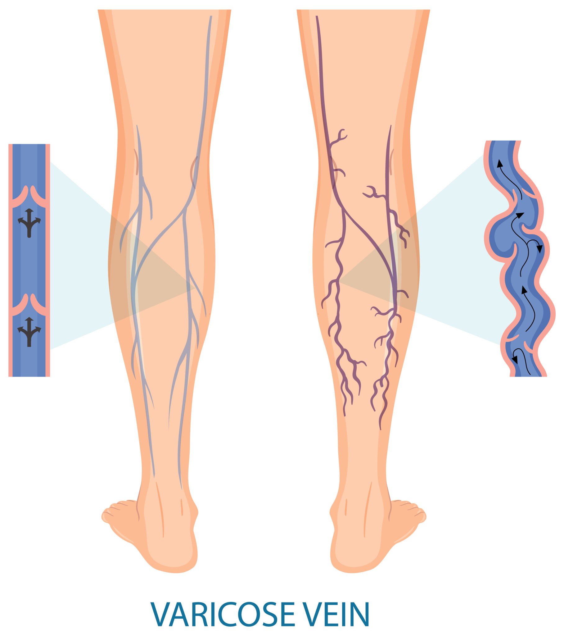 Piernas Cansadas Insuficiencia Venosa Dr Sabo Alloca Piernas Cansadas Insuficiencia Venosa Dr Sabo Alloca